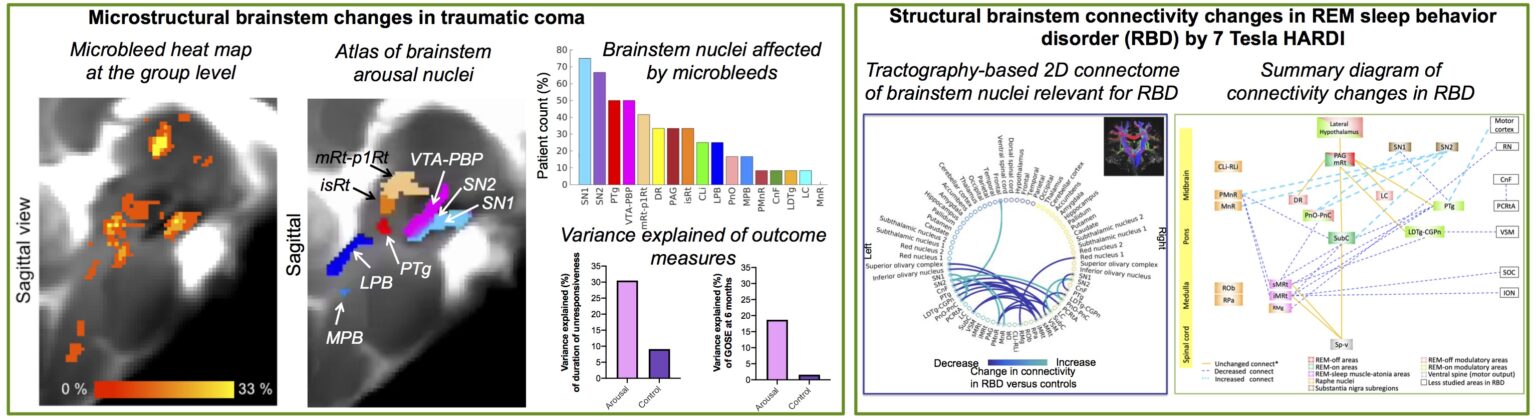 Research – The Brainstem Imaging Laboratory